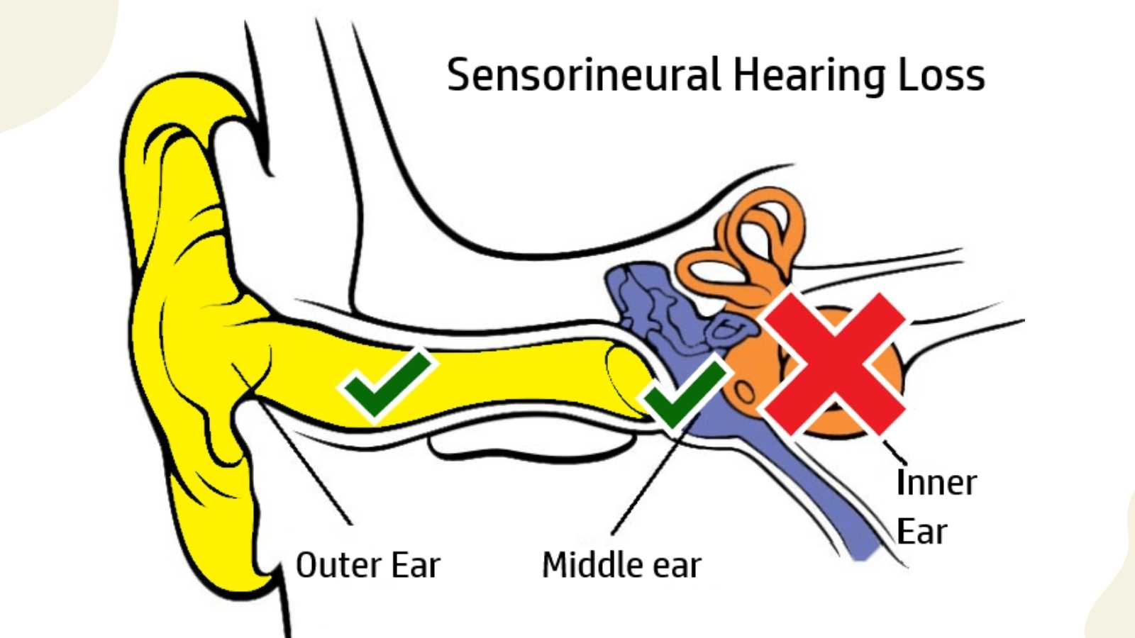 What Is Sensorineural Hearing Loss Causes Treatments Tests